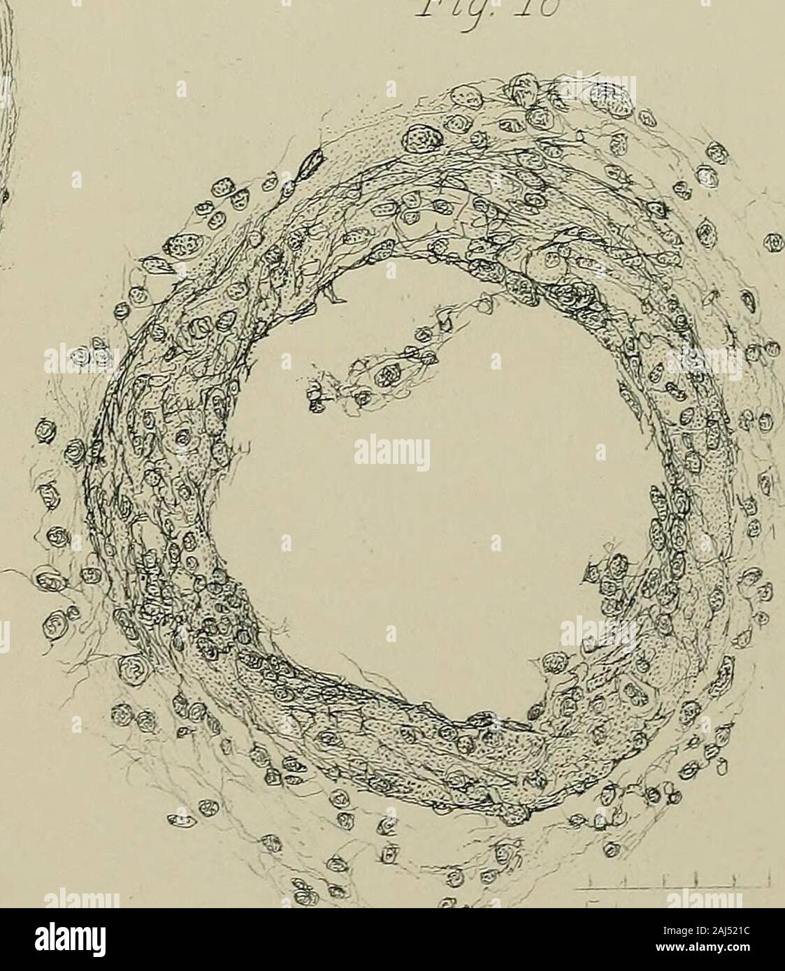 Endarteritis High Resolution Stock Photography and Images - Alamy