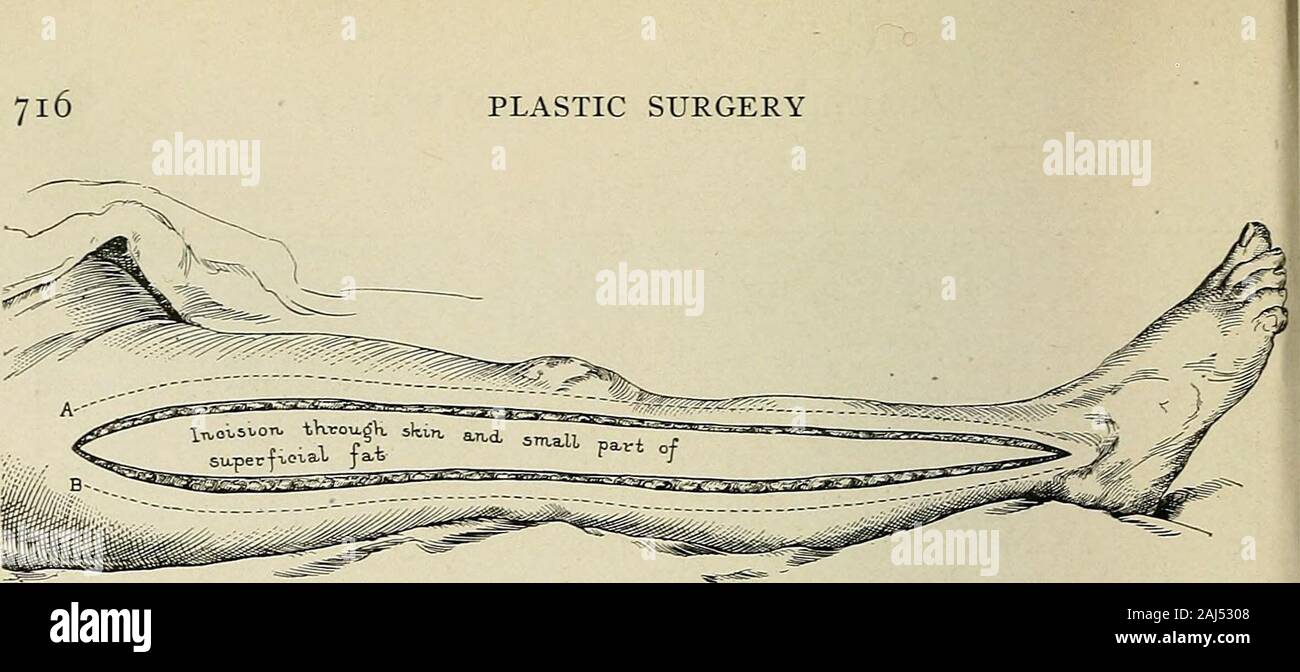Plastic surgery; its principles and practice . Fig. 859. Fig. 860 ...