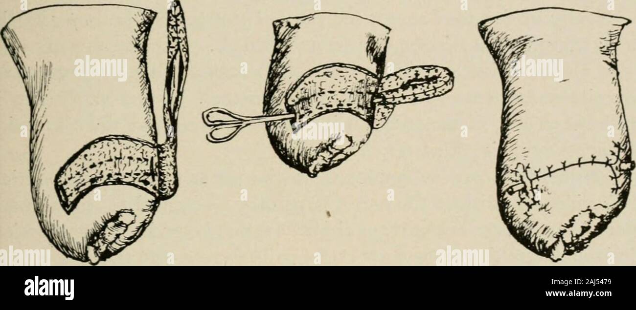 Plastic surgery; its principles and practice . CUT END OF TWCEPS Pig ...