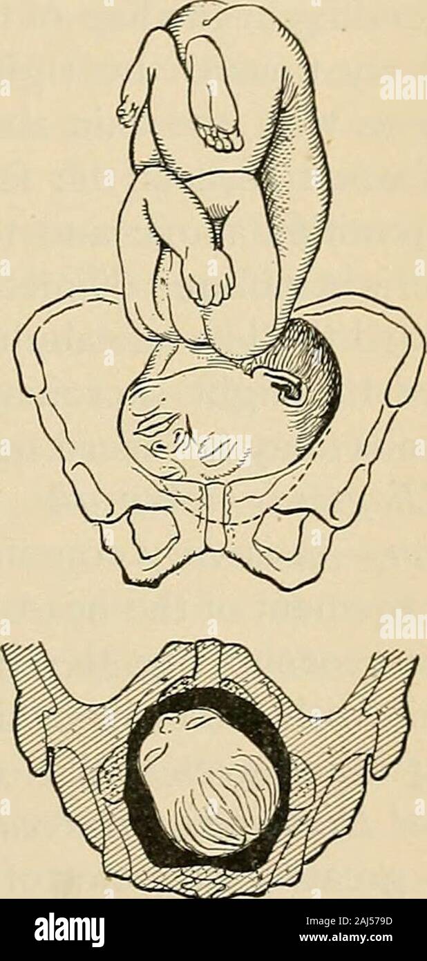 A manual of obstetrics . Fig. io8.—Brow presentation, R. F. P. Fig. 109 ...