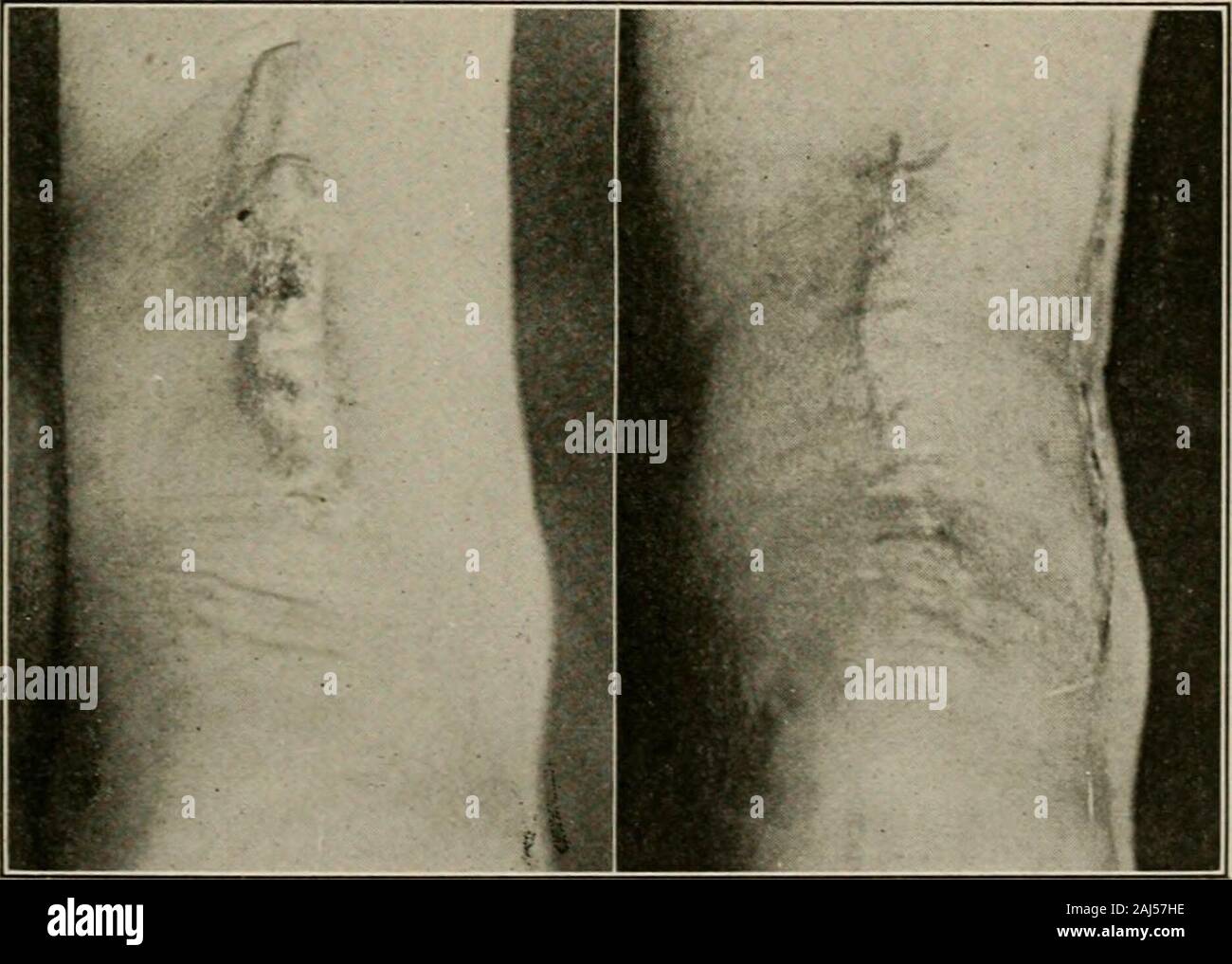 Graft skin plastic surgery hi-res stock photography and images - Alamy