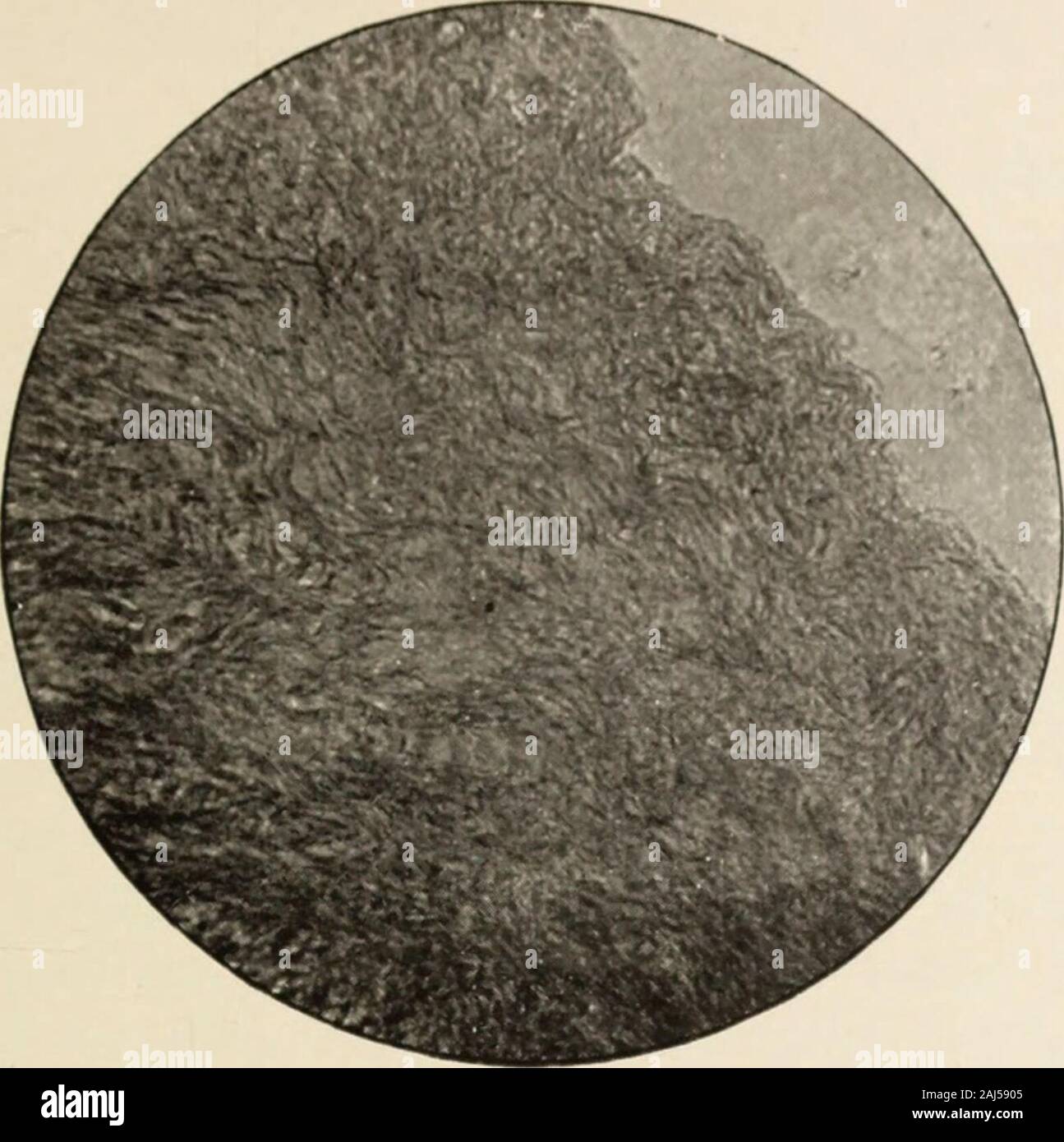 The Hahnemannian monthly . Gyroma of ovary; also multiplied and ...