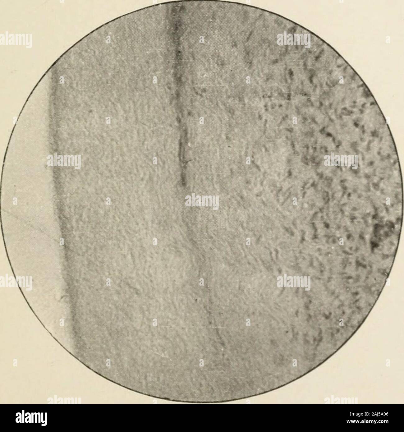 The Hahnemannian monthly . Thick layer of glandular cells on walls of a ...