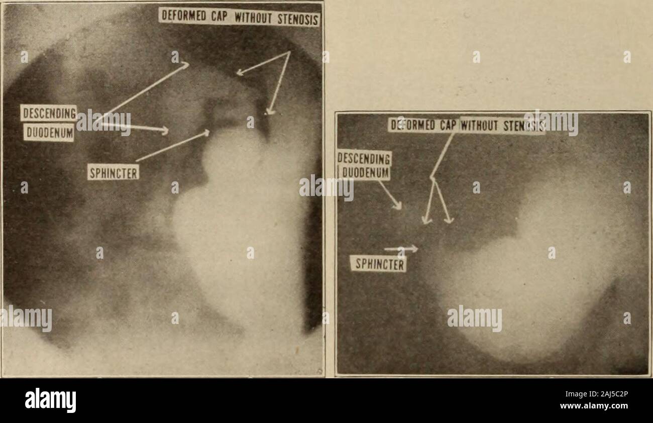 Hyperchlorhydria hi-res stock photography and images - Alamy