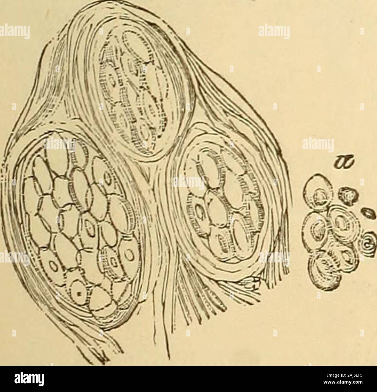 Simple cysts hi-res stock photography and images - Alamy