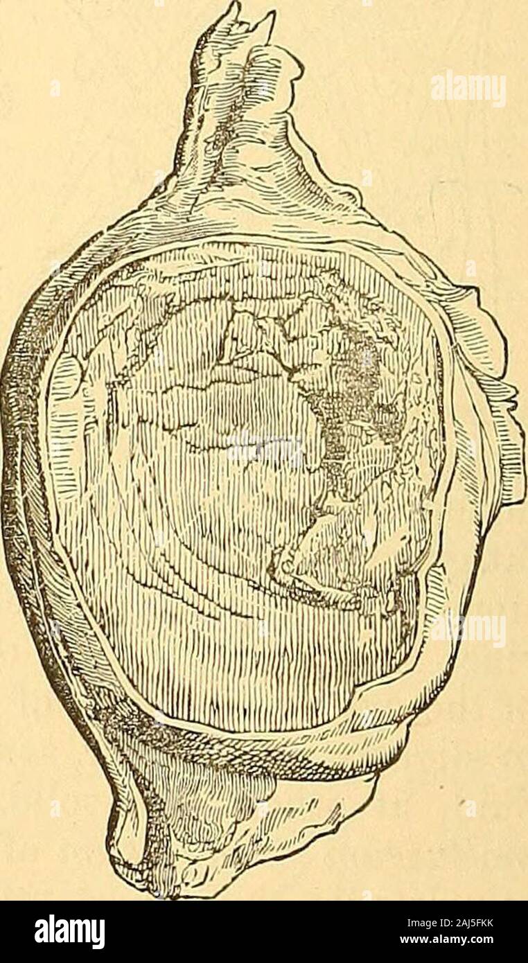 Cholesteatoma hi-res stock photography and images - Alamy