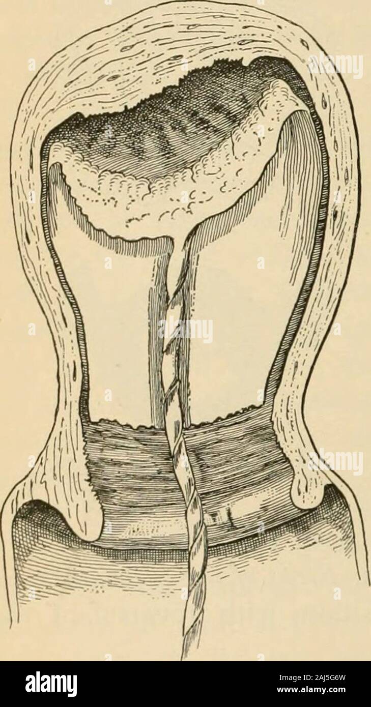 Placental attachment hi-res stock photography and images - Alamy