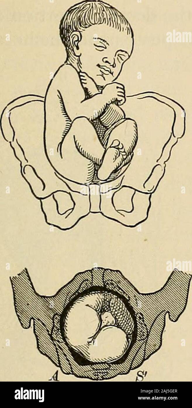 A manual of obstetrics . —The sameas in the first position. Steps of ...