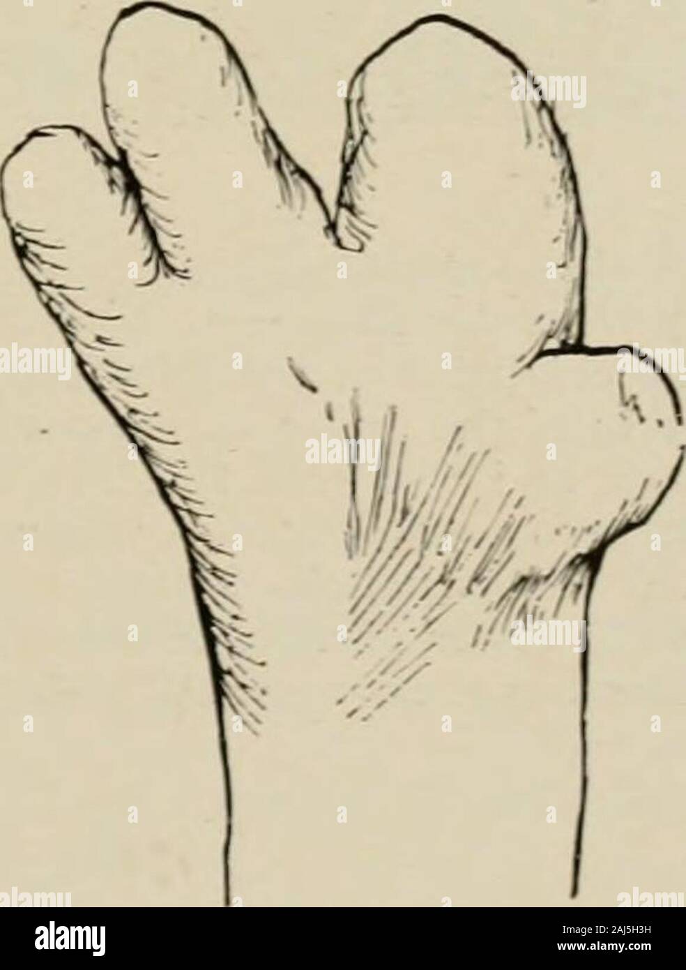 Plastic surgery; its principles and practice . Fig. 791.—Method of ...