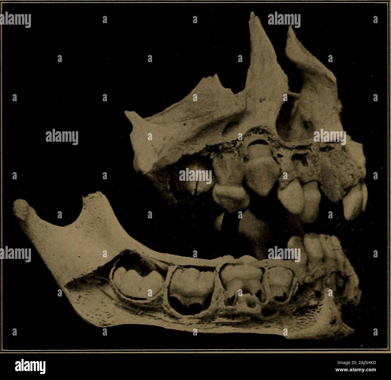 Cancellous bone hi-res stock photography and images - Alamy