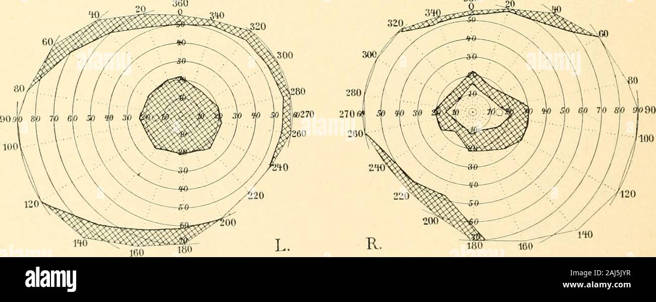 Chorioretinitis hi-res stock photography and images - Alamy