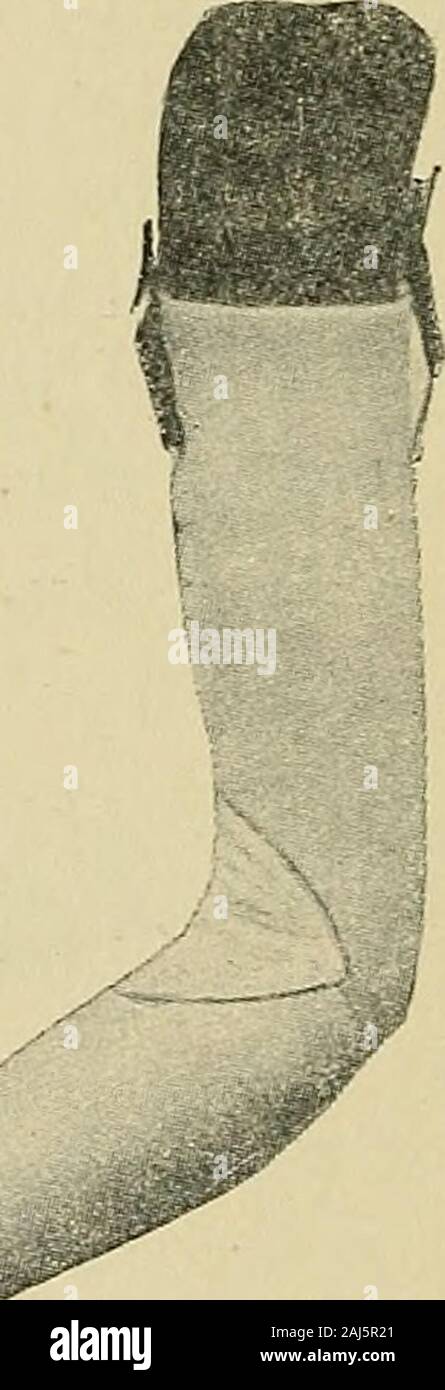 Lisfrancs amputation hi-res stock photography and images - Alamy