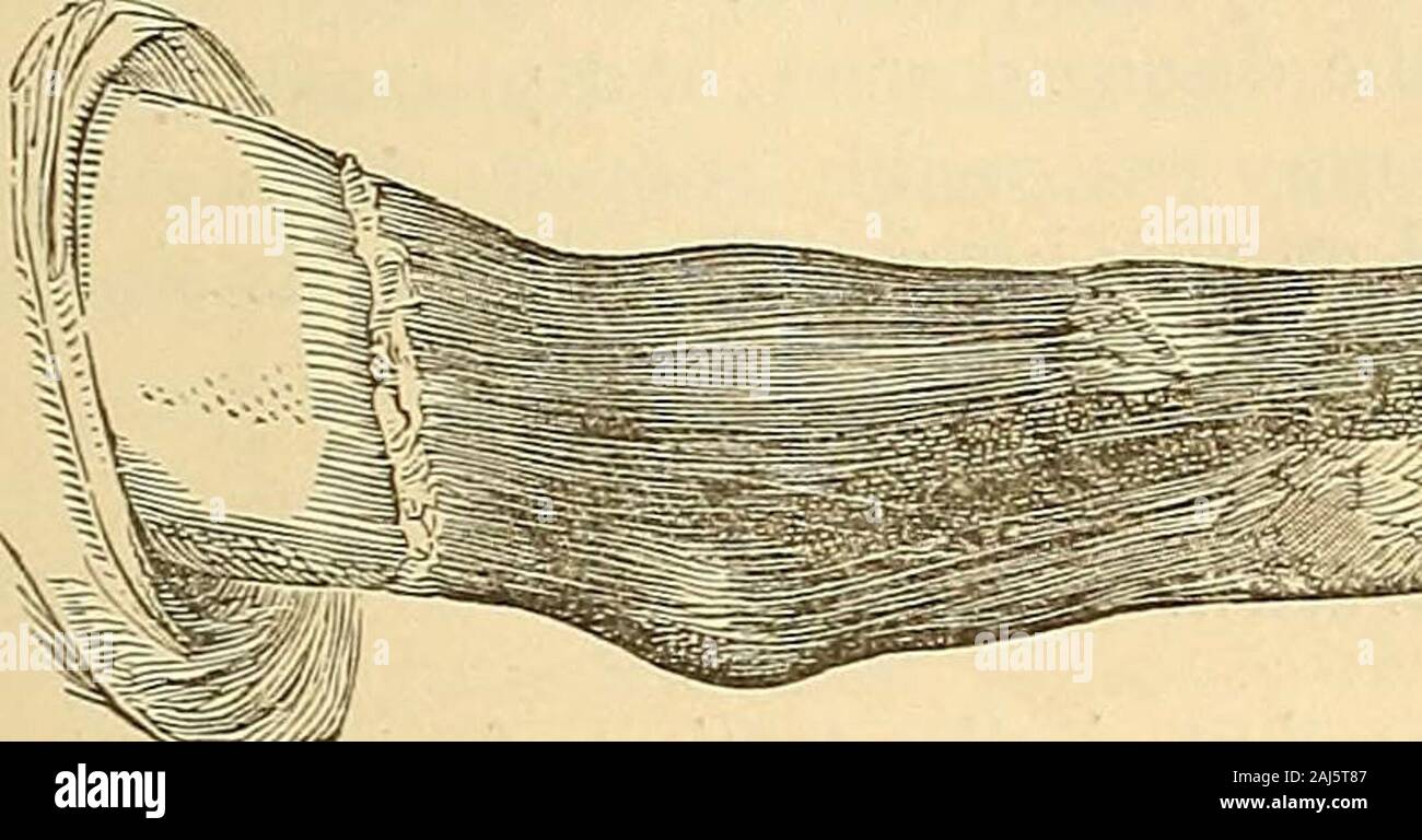 Compound fracture hi-res stock photography and images - Alamy