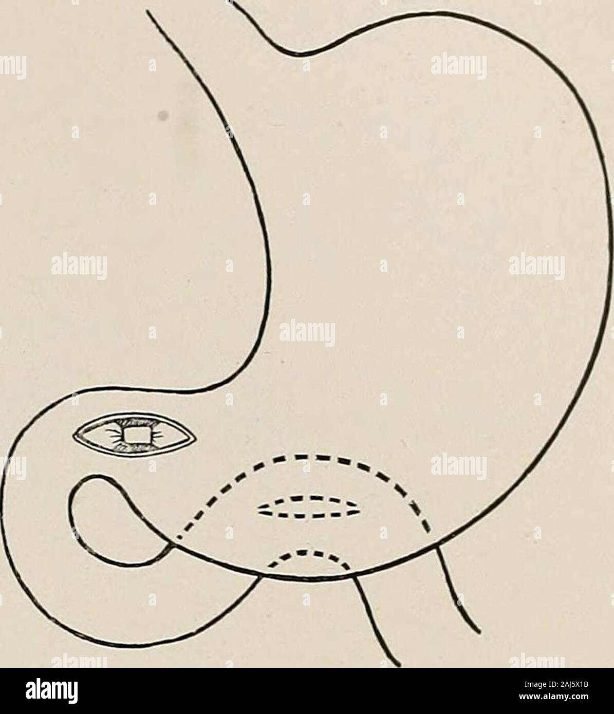 Double ligation hi-res stock photography and images - Alamy