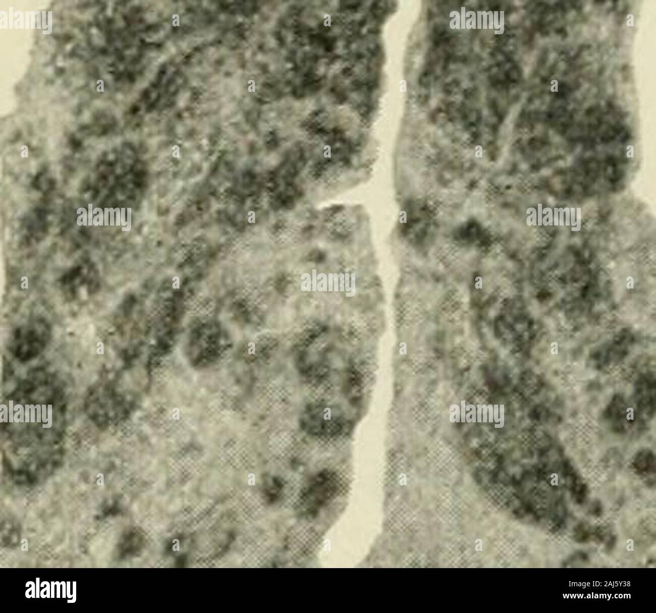 Intussusception intestine hi-res stock photography and images - Alamy