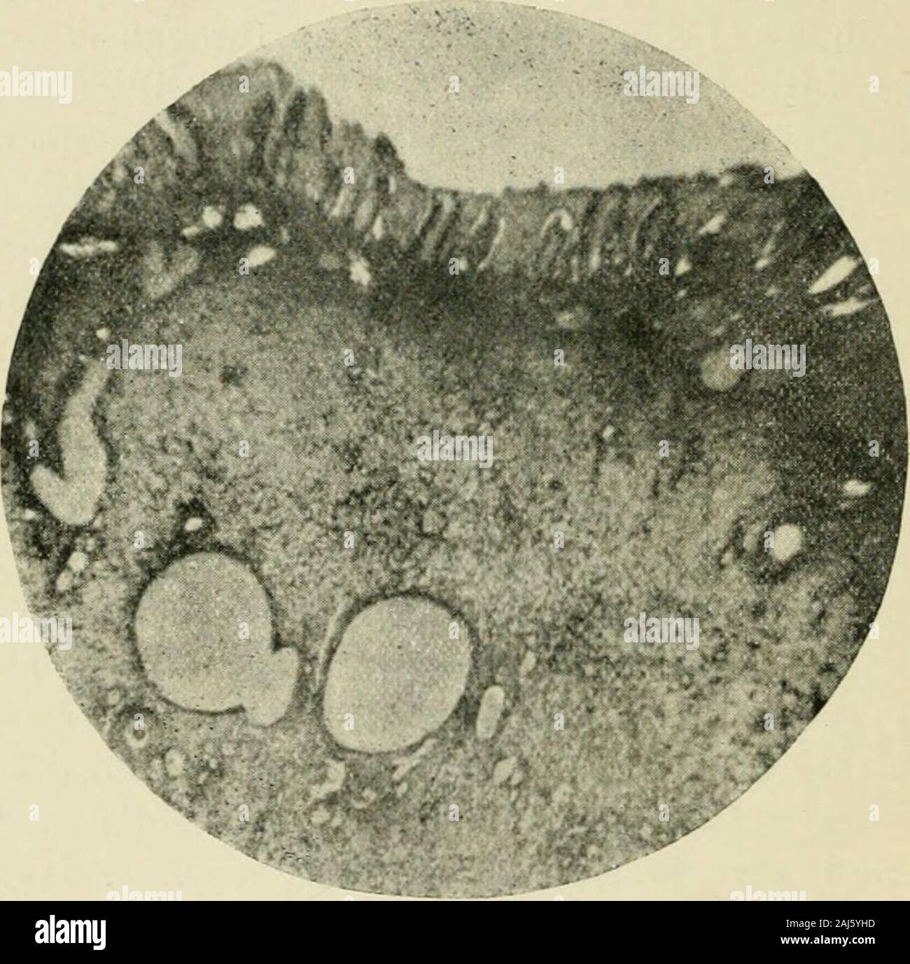 Some points in the anatomy, pathology, and surgery of intussusception ...