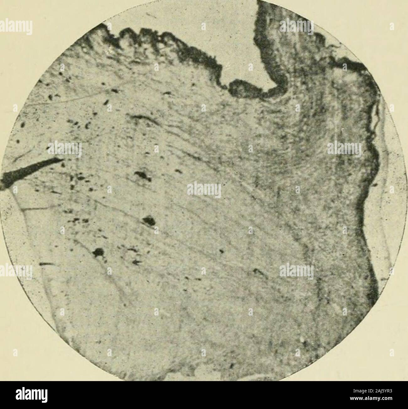 Intussusception hi-res stock photography and images - Alamy