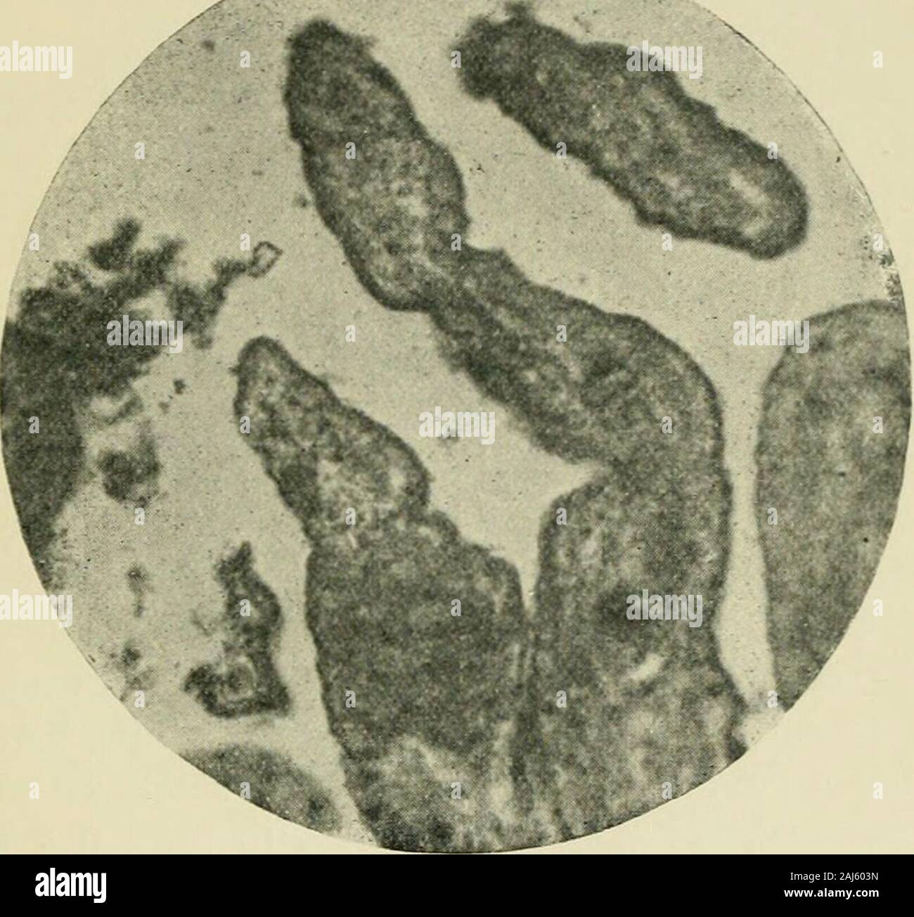 Intussusception intestine hi-res stock photography and images - Alamy