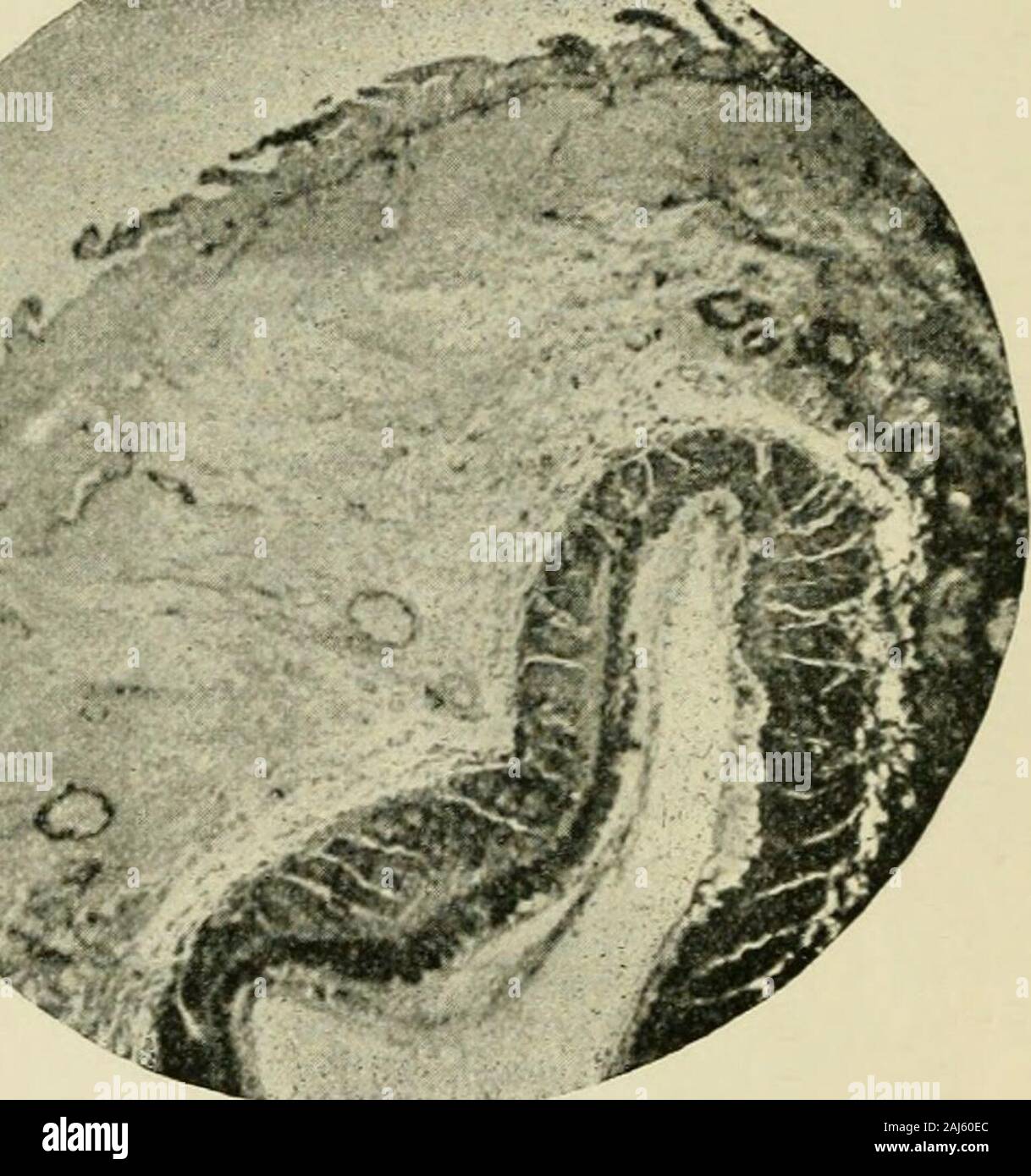 Some points in the anatomy, pathology, and surgery of intussusception ...