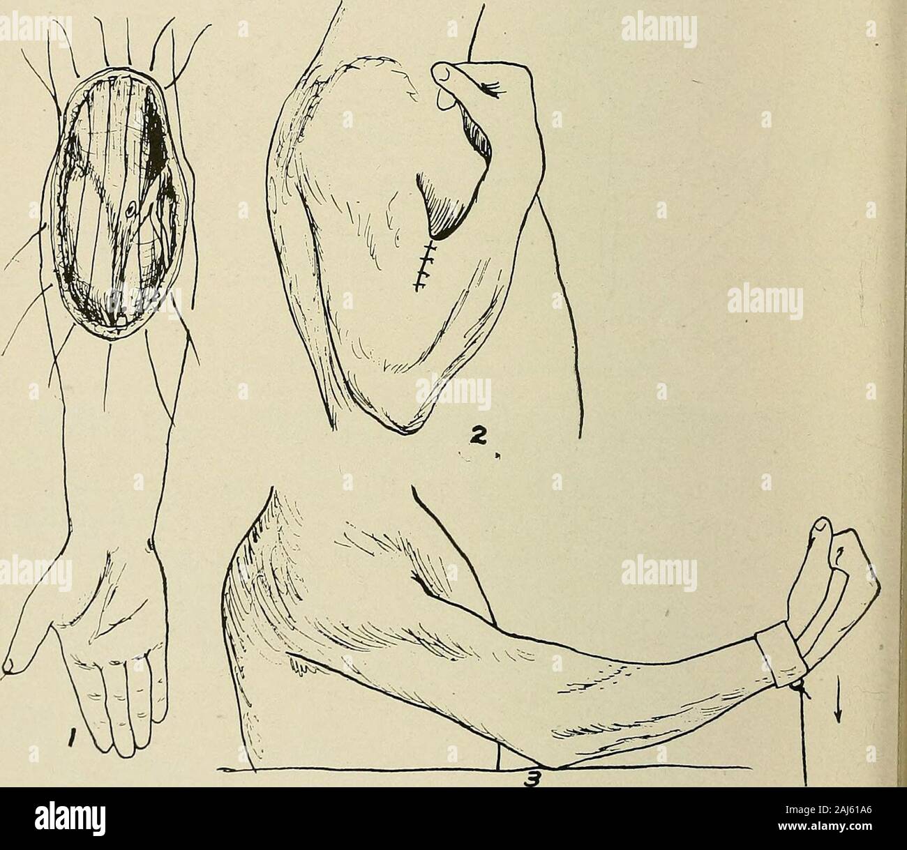 Scar contracture hi-res stock photography and images - Alamy