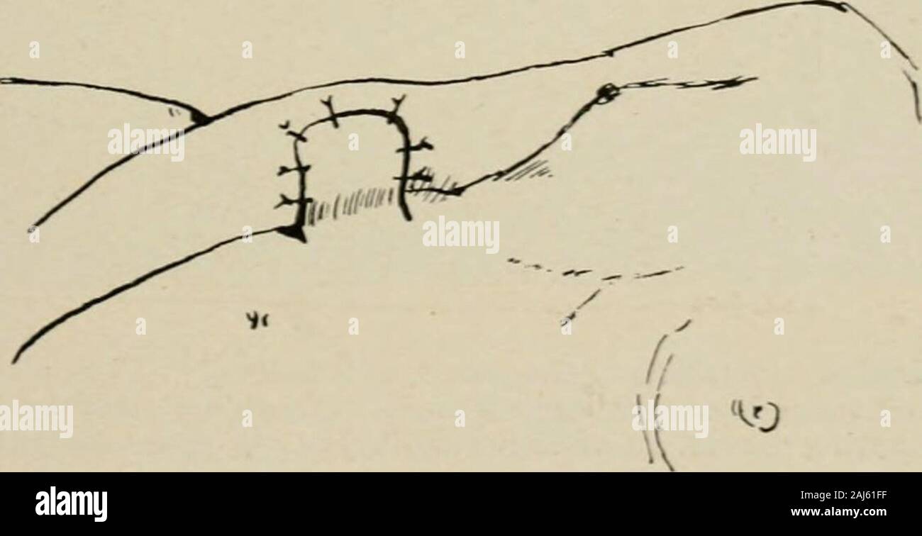 Excision band hi-res stock photography and images - Alamy