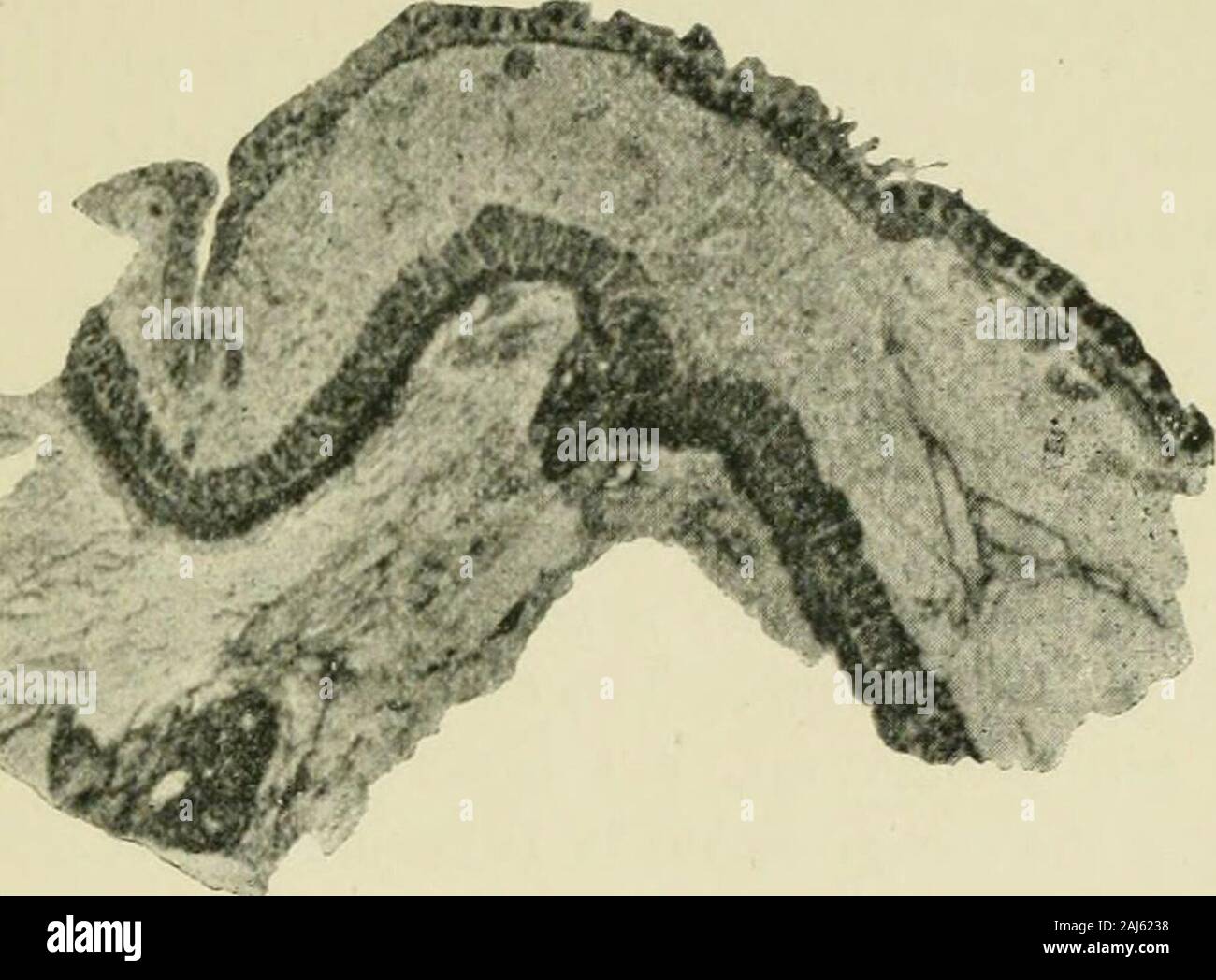 Intussusception hi-res stock photography and images - Alamy