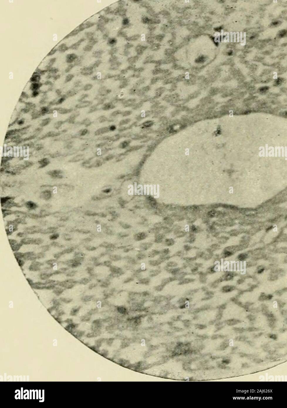 Some points in the anatomy, pathology, and surgery of intussusception ...