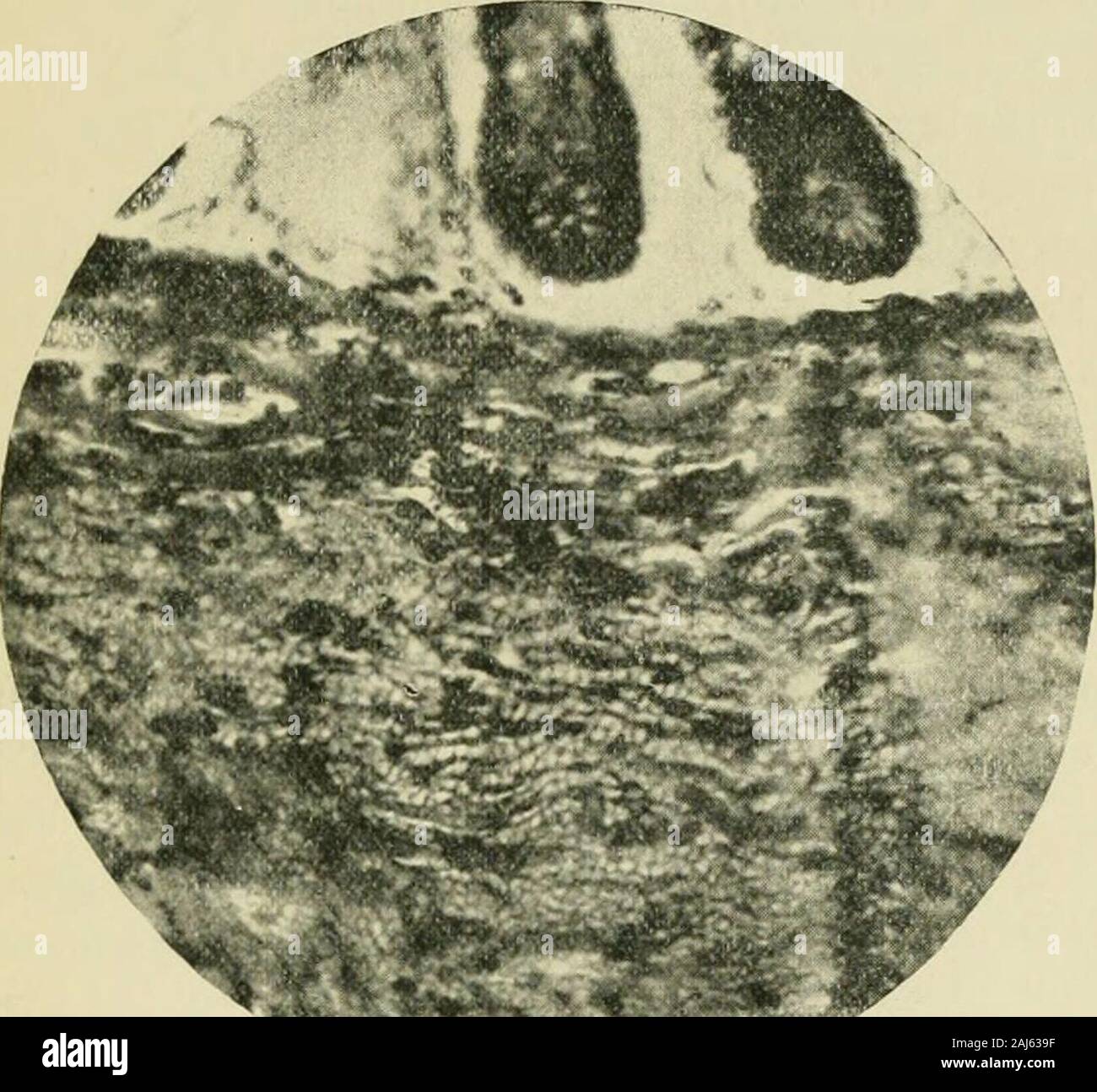 Some points in the anatomy, pathology, and surgery of intussusception ...
