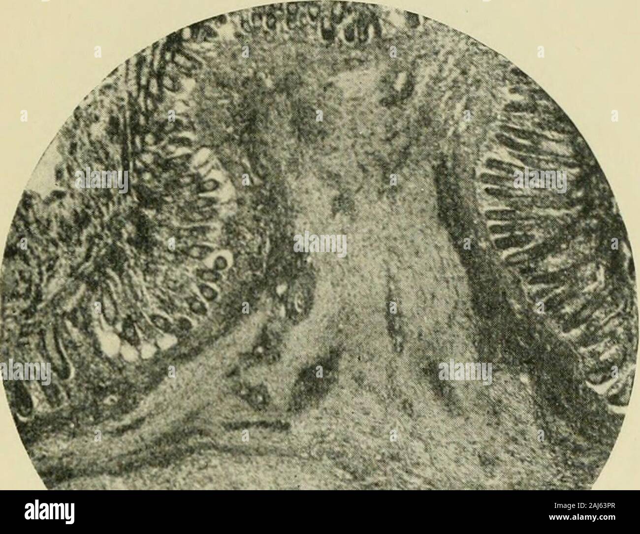 Intussusception intestine hi-res stock photography and images - Alamy