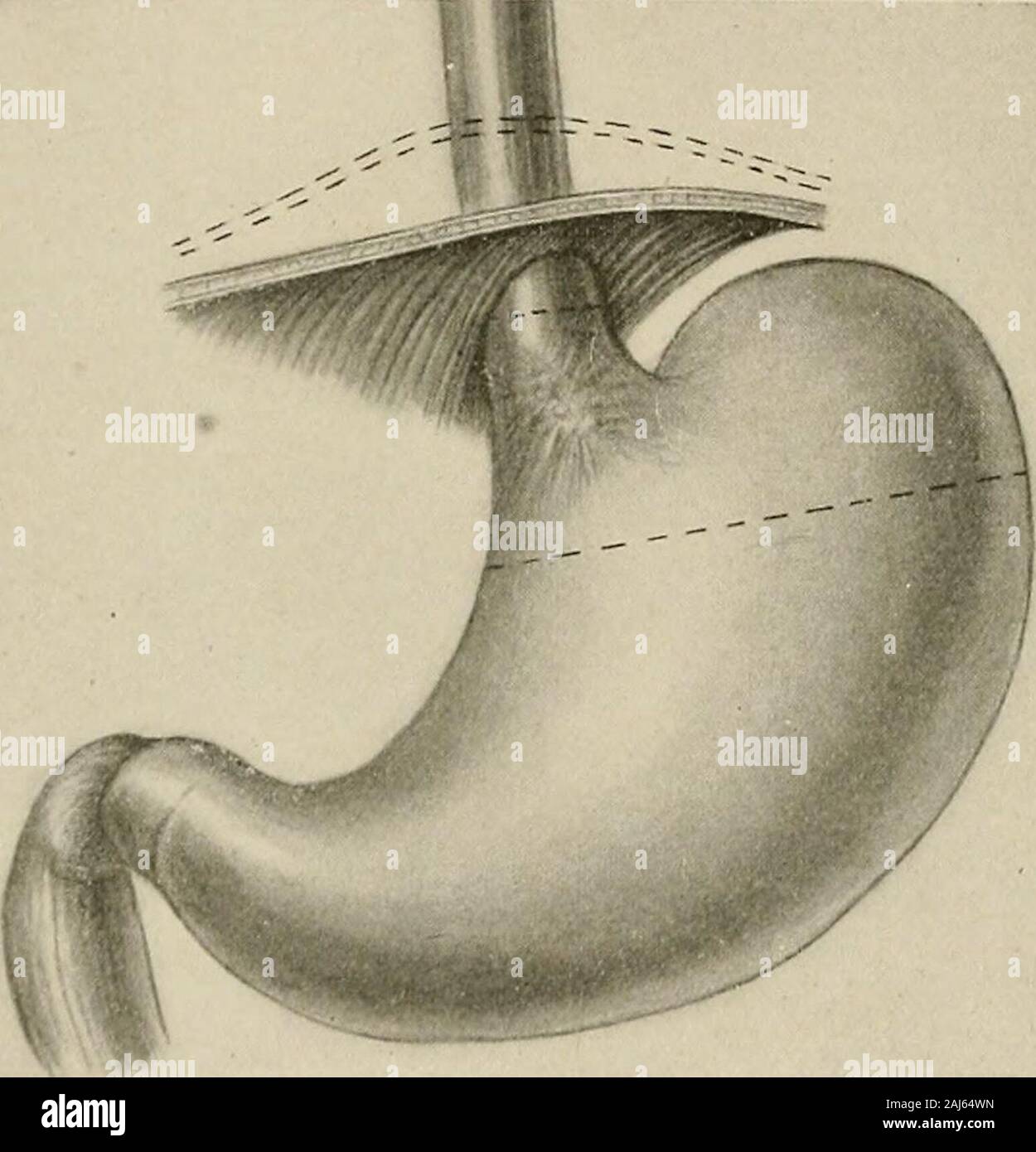 Anastomosis distal hi-res stock photography and images - Alamy