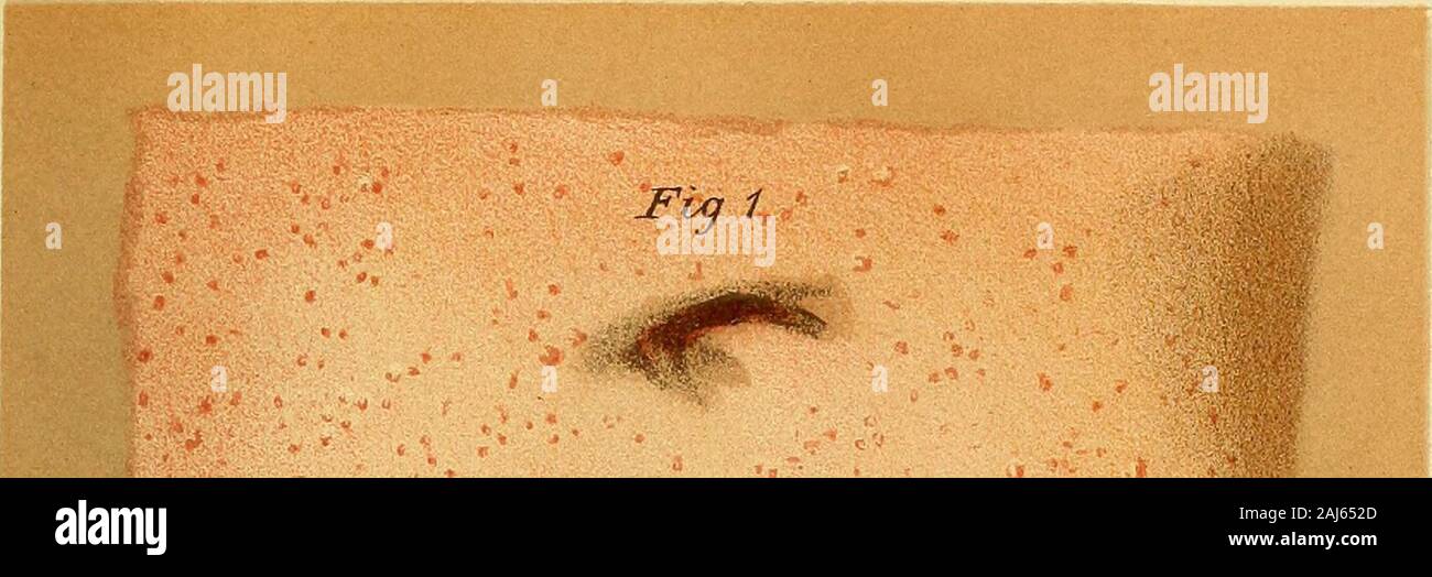 Syphilis Ulcers High Resolution Stock Photography and Images - Alamy