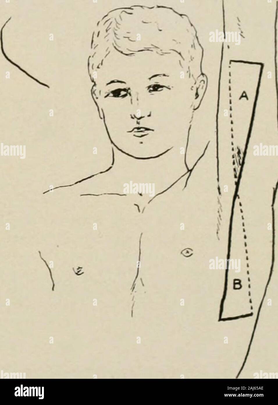 Plastic surgery; its principles and practice . Fig. 739.—Operation for ...