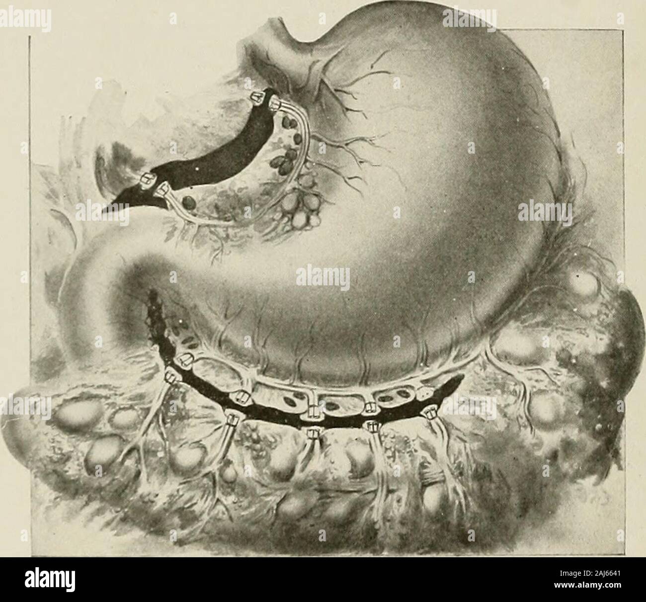 Left gastric artery hi-res stock photography and images - Alamy