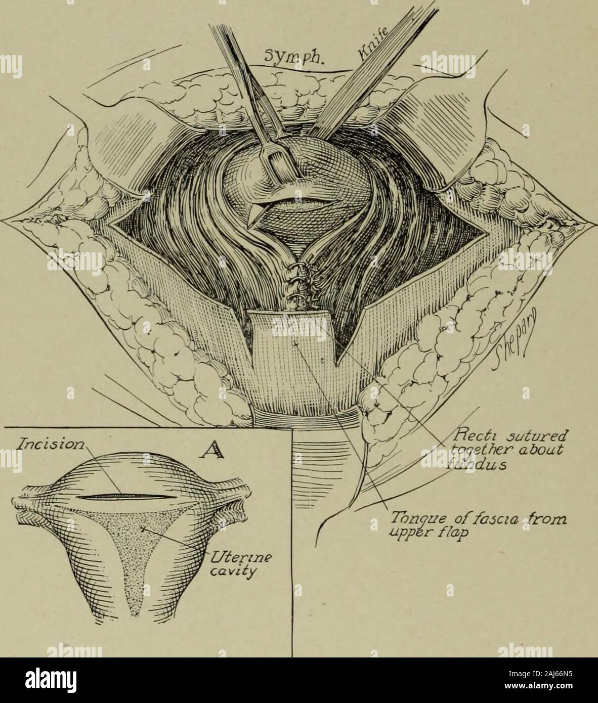 Fundus of uterus hi-res stock photography and images - Alamy