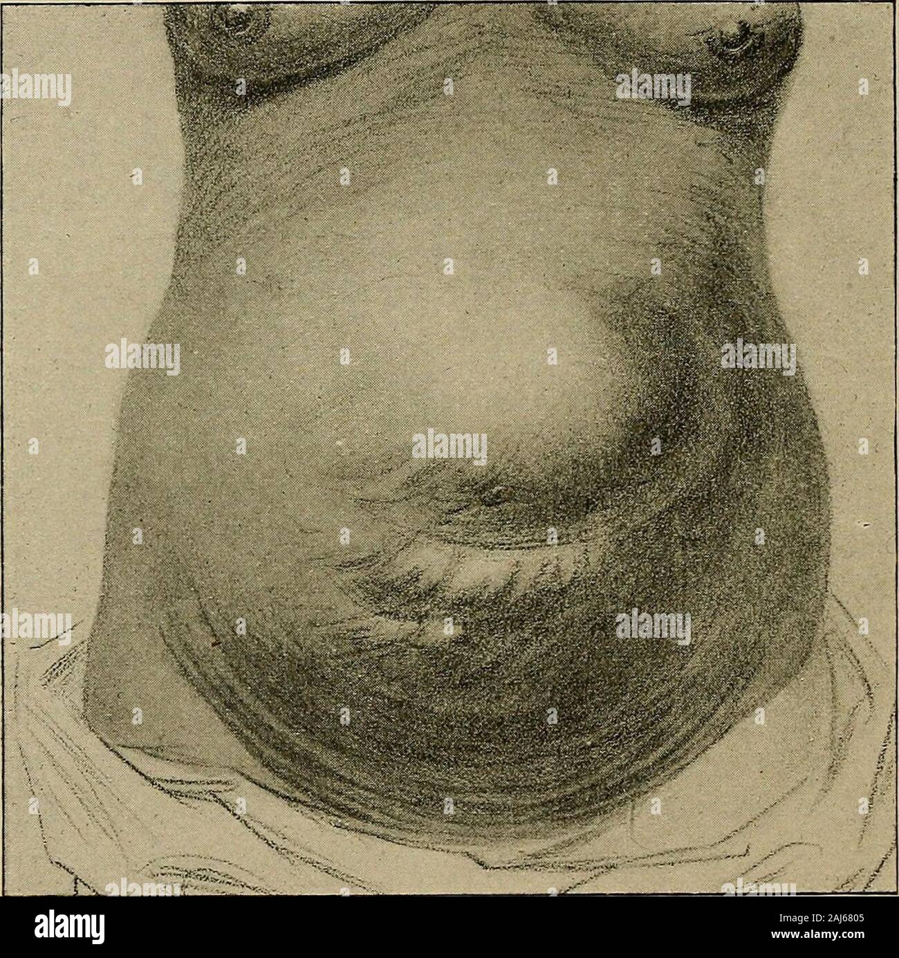 Cancer of the stomach : a clinical study . o the lesser curvature ...
