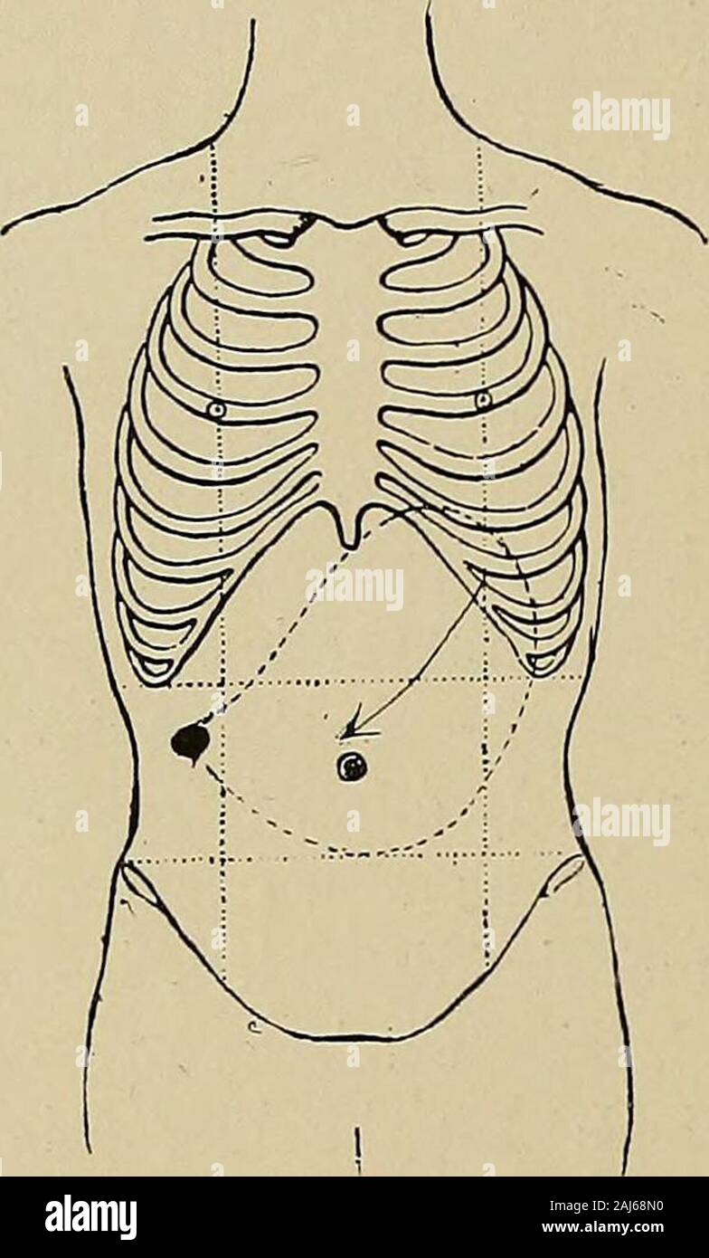 Cancer of the stomach : a clinical study . eleft border of the sternum ...