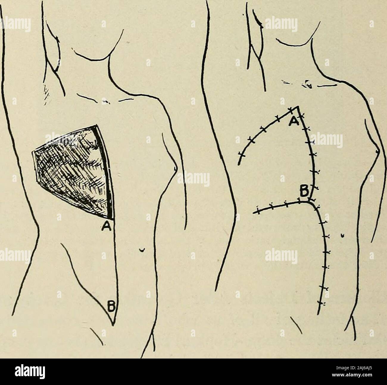 Plastic surgery; its principles and practice . I 2 Pig. 720.—Operation ...