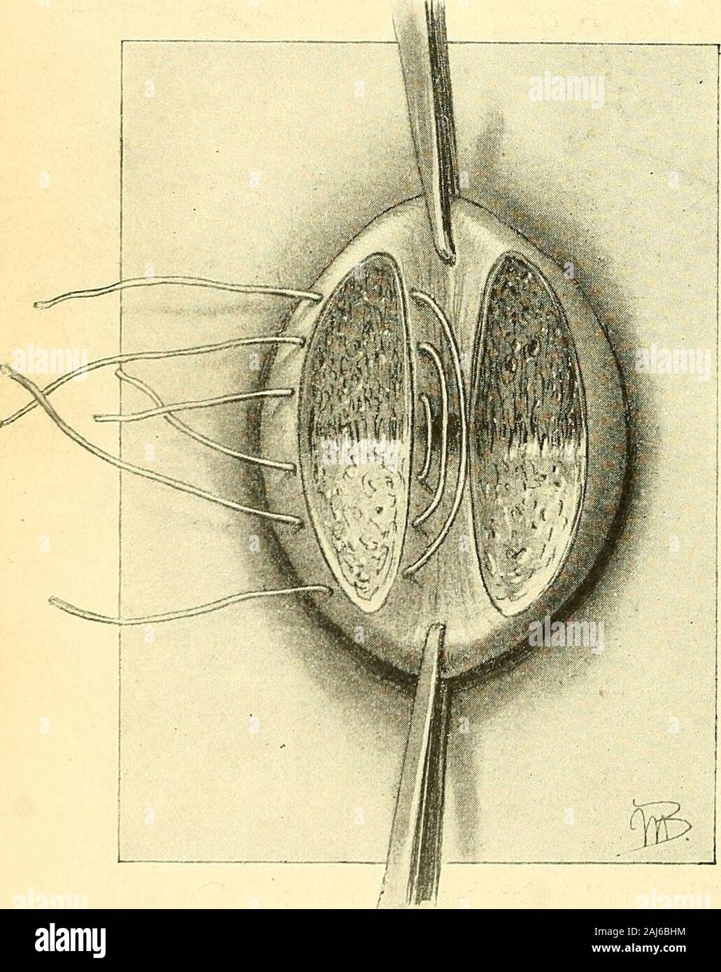 Operative gynecology : . Fig. 335.—Bilateral Laceration of the Cer-vix ...