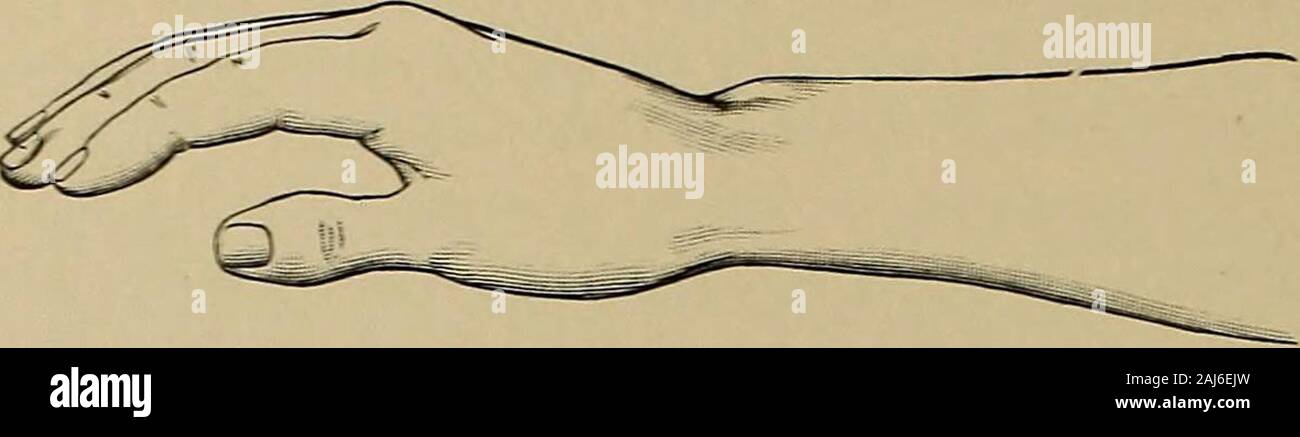 Palm fractures hi-res stock photography and images - Alamy