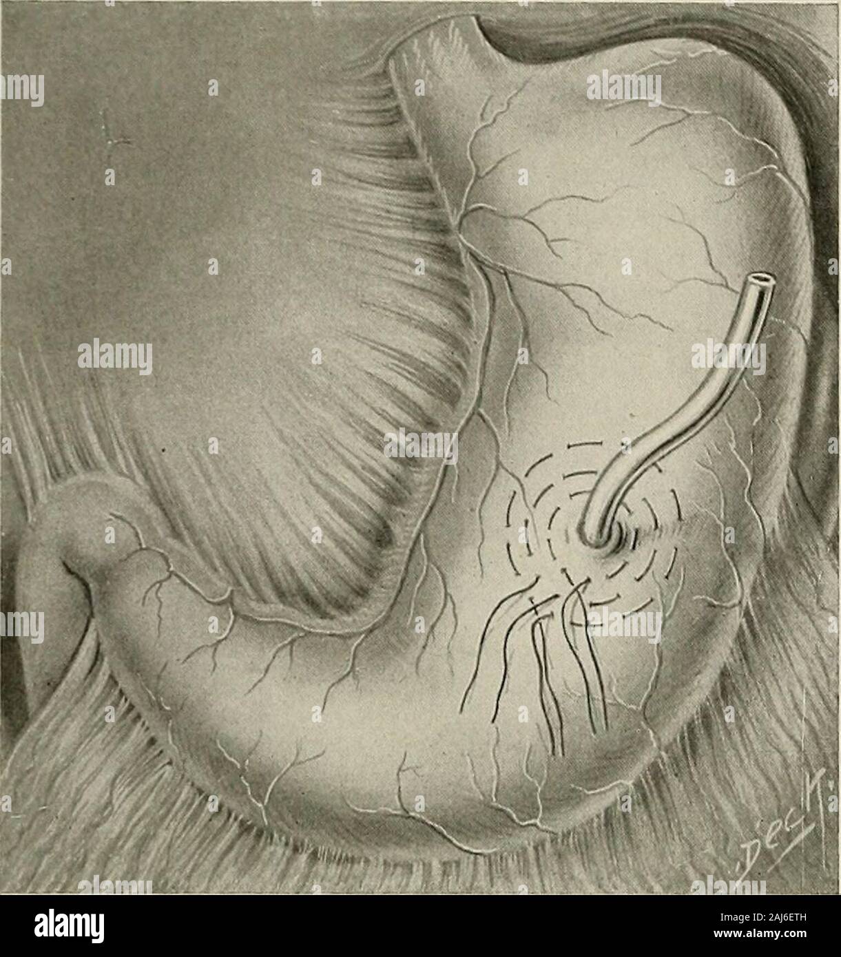 Gastrostomy hi-res stock photography and images - Alamy