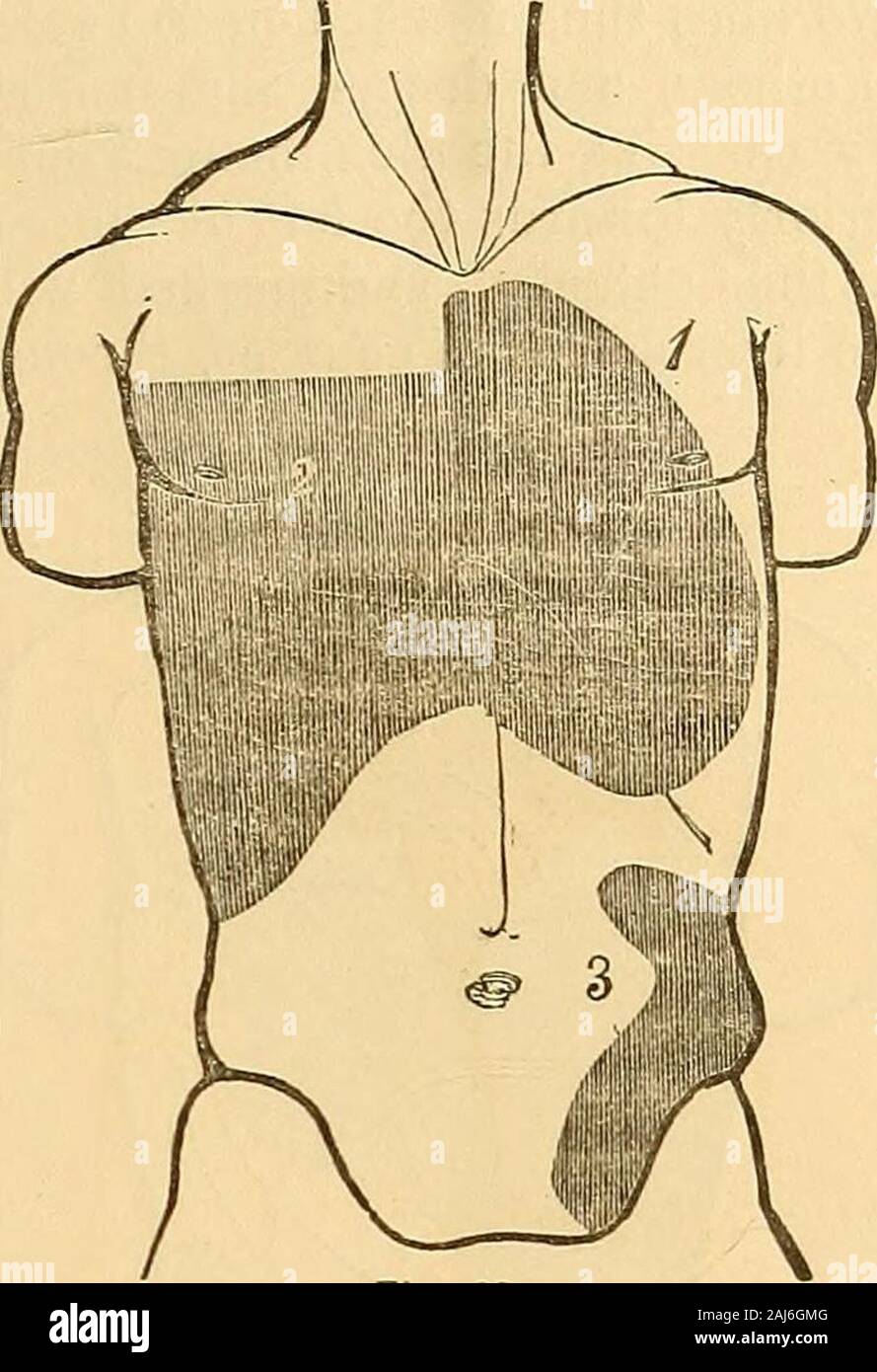 Hypertrophy ventricle hi-res stock photography and images - Alamy
