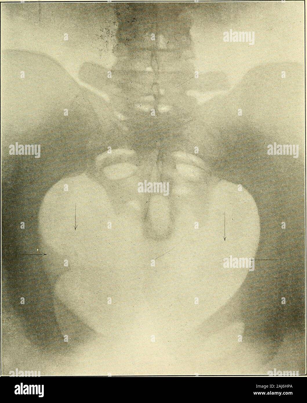 Operative gynecology : . re was, however,a small contracted kidney, and ...