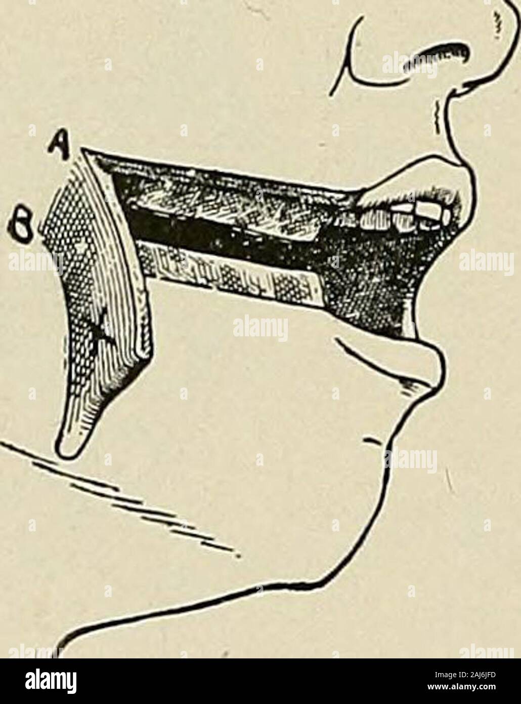 Contracture splint hi-res stock photography and images - Alamy