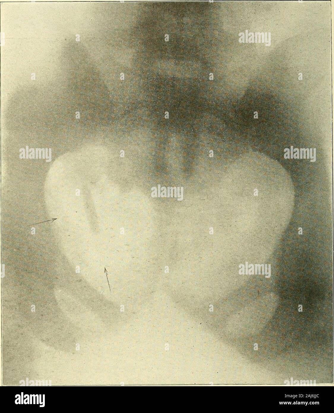 Operative gynecology : . Fig. 314, -Two Calculi in the Right Kidney ...