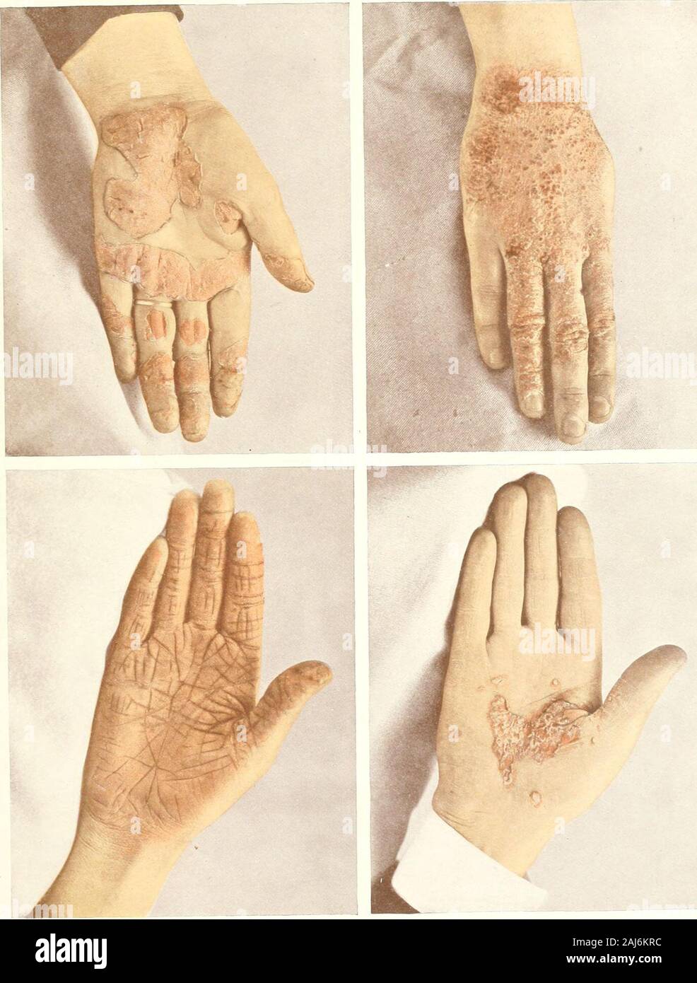 Papular eczema hi-res stock photography and images - Alamy