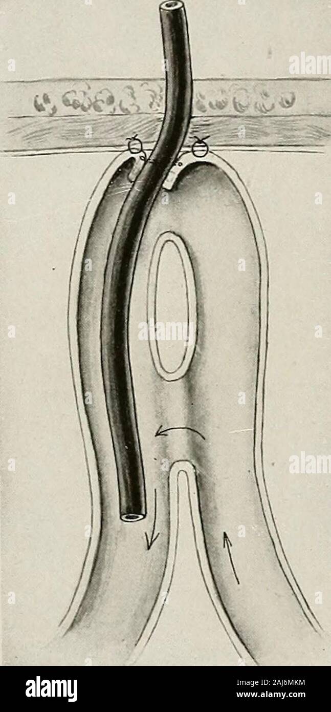 Hyperchlorhydria hi-res stock photography and images - Alamy