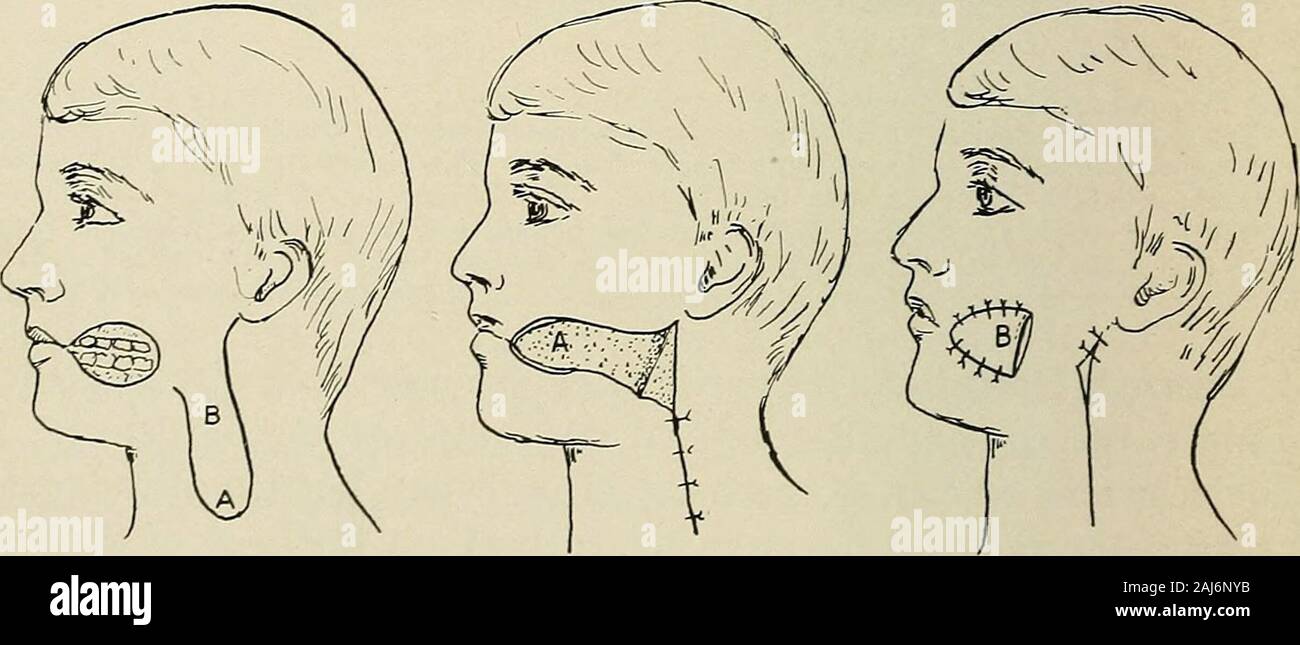 Plastic surgery; its principles and practice . Pig. 676.—Czernys ...