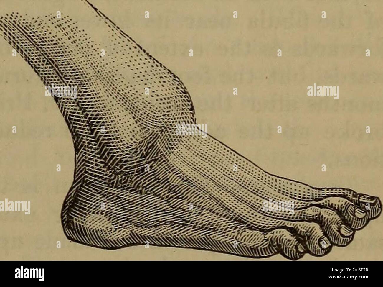 A practical treatise on fractures and dislocations . Partial ...