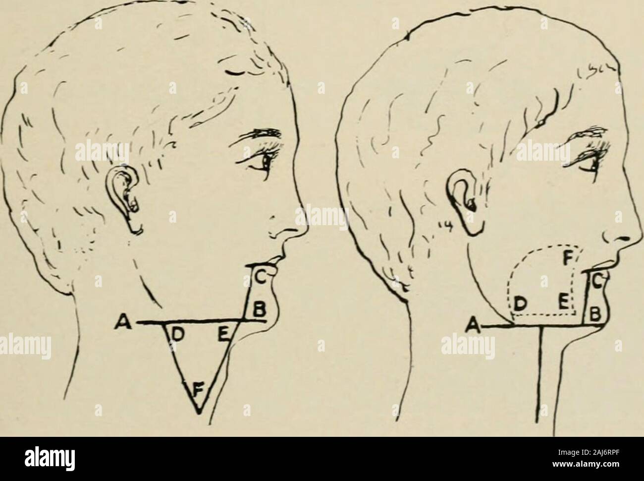 Plastic surgery; its principles and practice . Fig. 669.—Operation for ...