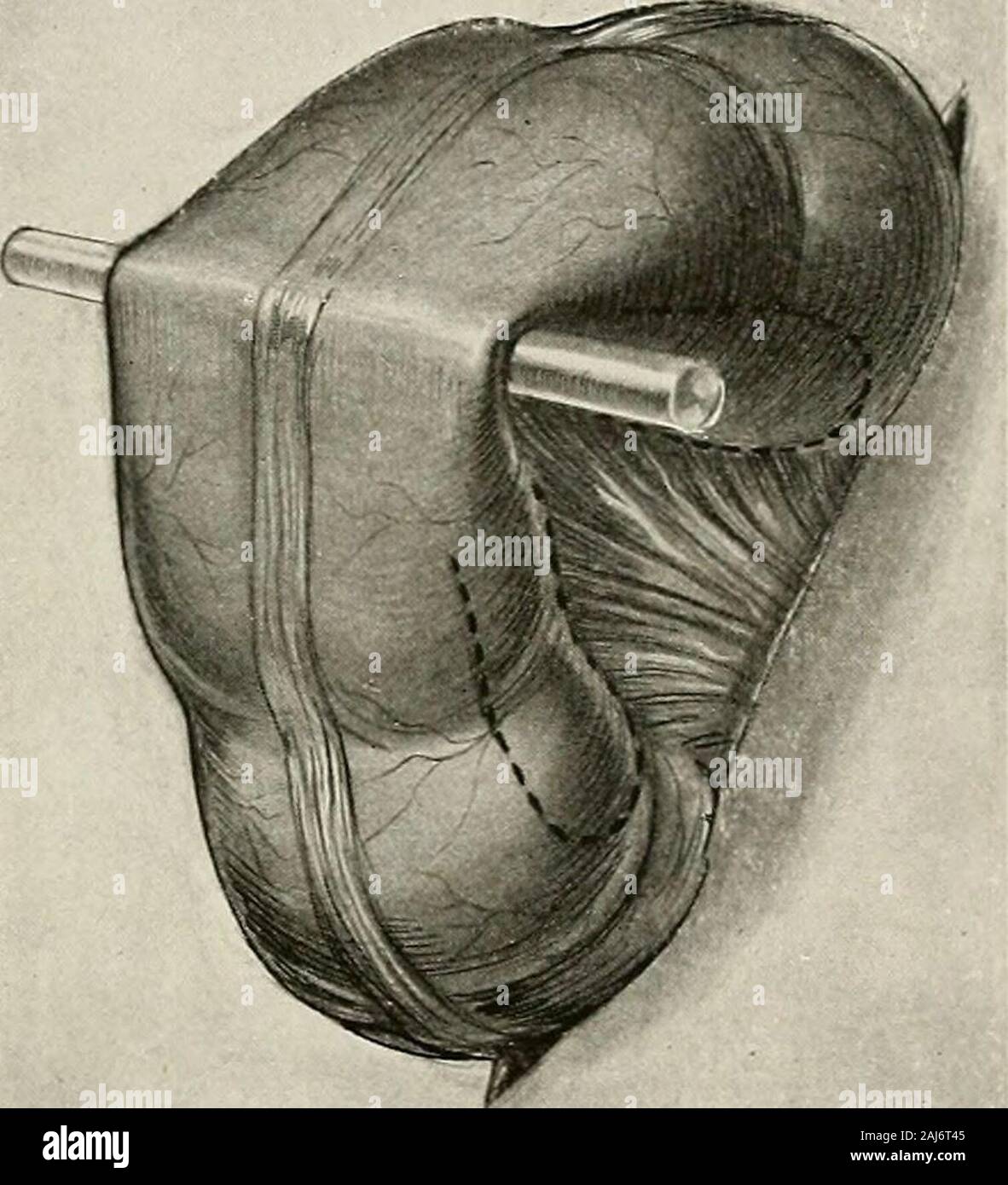 Gut suture hi-res stock photography and images - Alamy
